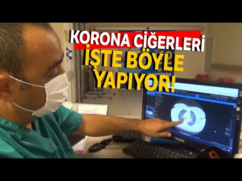 Korona Virüse Yakalanan Hastaların Ciğerlerindeki Dehşet Veren Görüntü