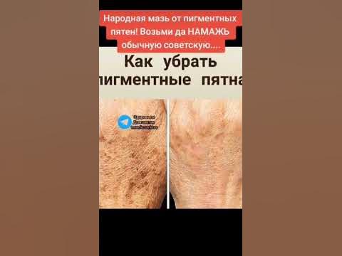 народная мазь от пигментных пятен #народнаямедицина #здоровье # ...
