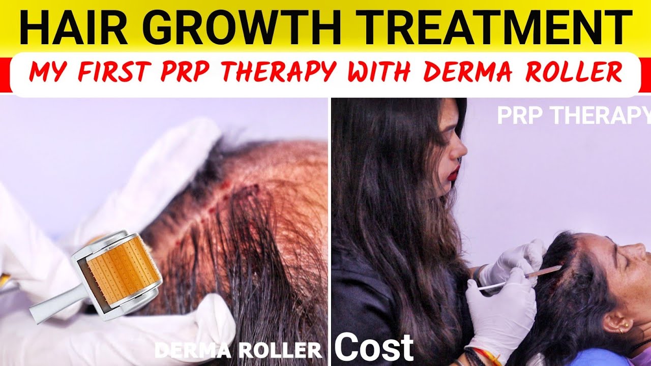 My First PRP Therapy With Derma Roller in India 2023 || Female Hair ...