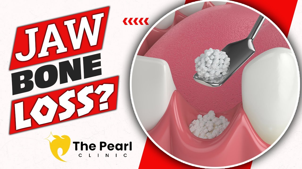 Jaw Bone Weak? See How Bone Grafting Can Fix It Fast! - YouTube