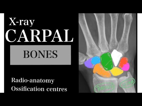 X-ray of Carpal bones and ossification centres of wrist l Radiographic ...