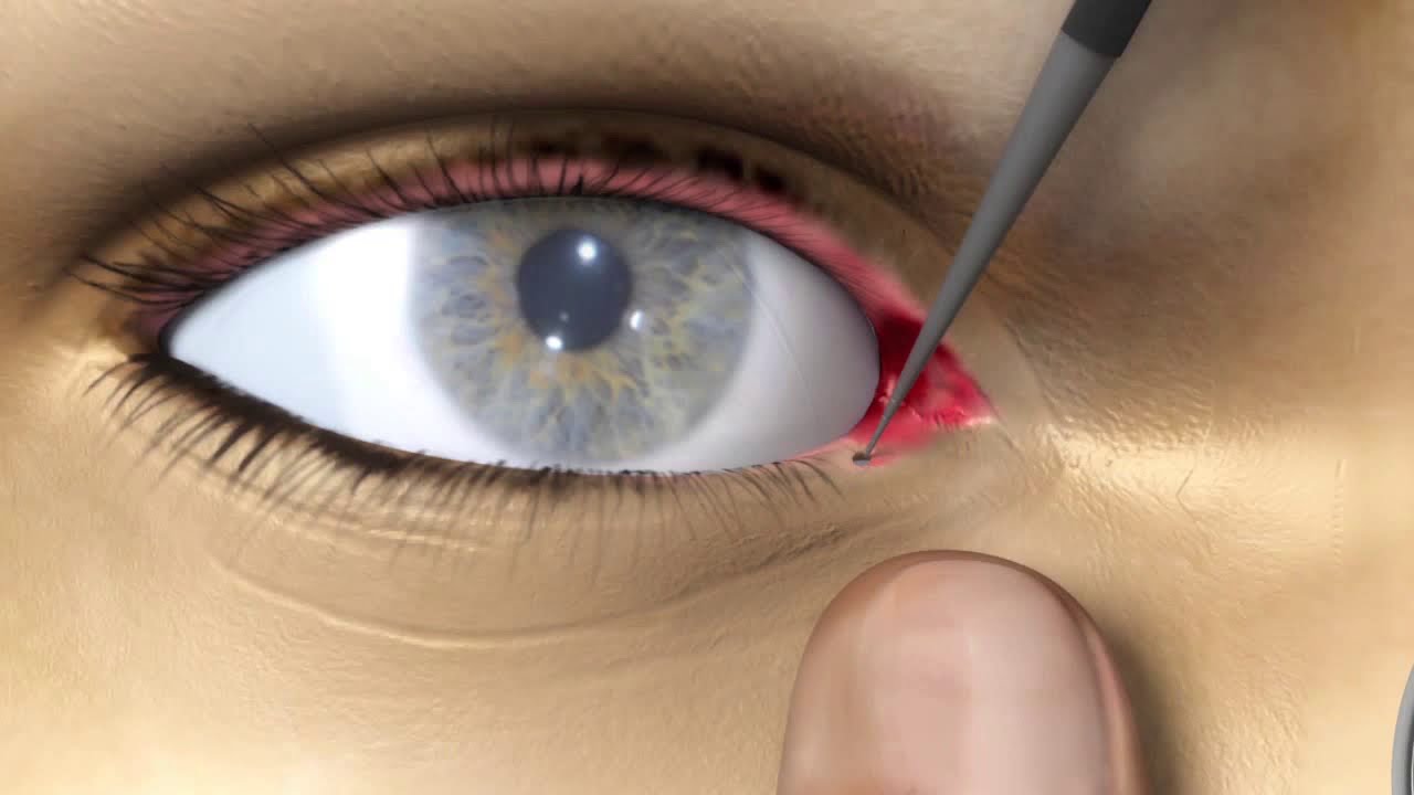 Katena Punctum Plug Insertion YouTube katena-punctum-plug-insertion-youtube