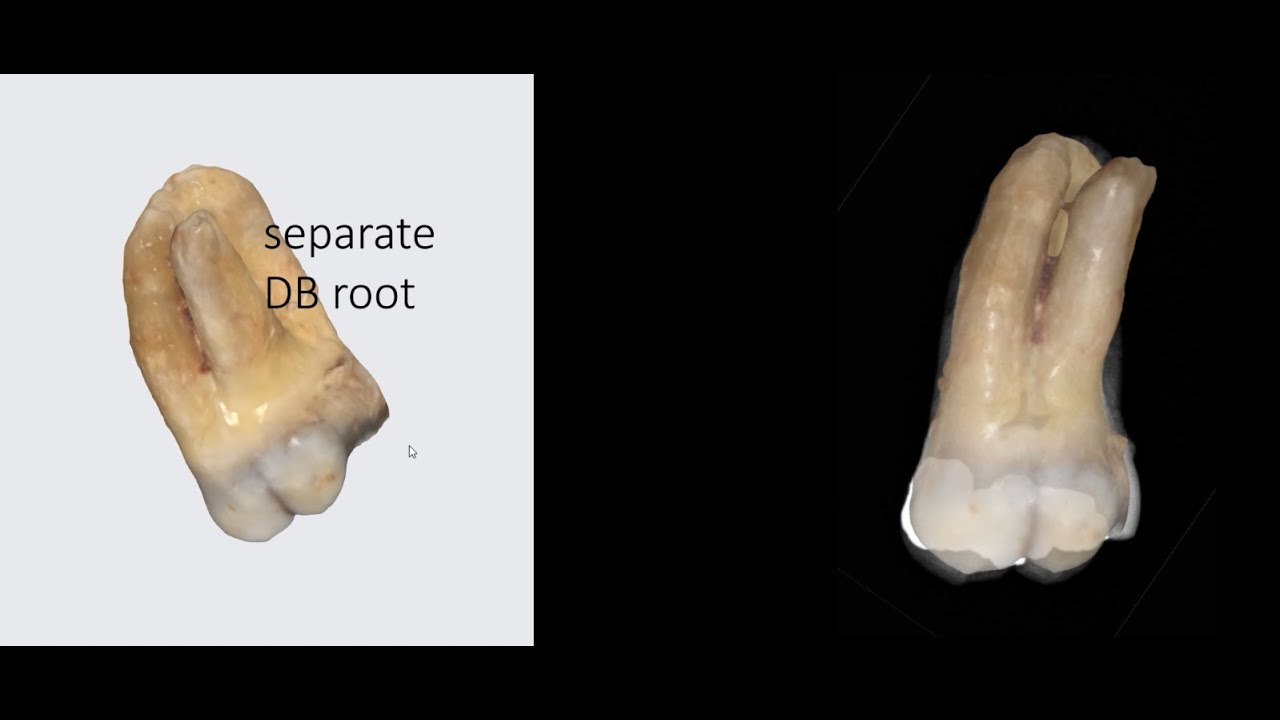 "Benchtop Endo 1- pt 1" - microscope molar endodontics on an extracted ...