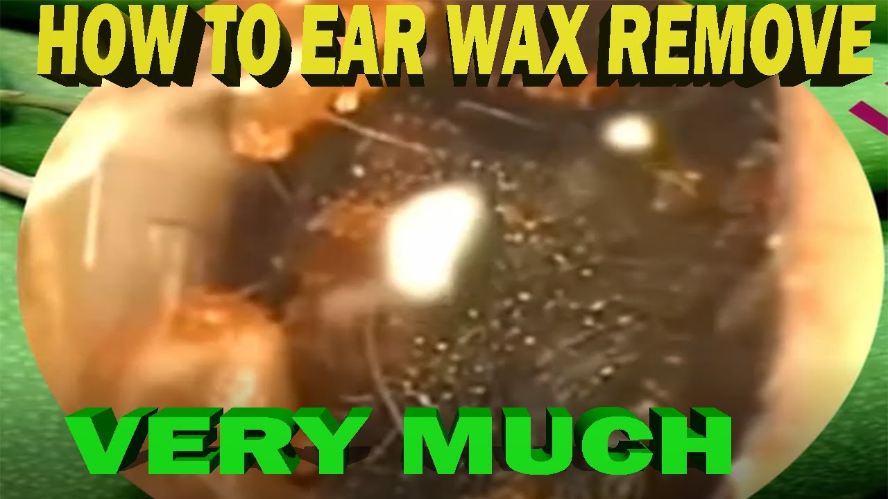 How To removal earwax at home with hydrogen peroxide .ear wax removal ...