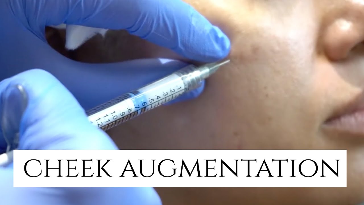 Add Volume to Your Cheeks in 15 Minutes! Non-Surgical Cheek ...