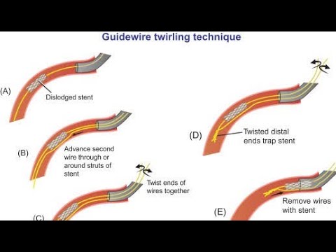 Guidewire Twirling technique for Coronary stent retrieval - YouTube