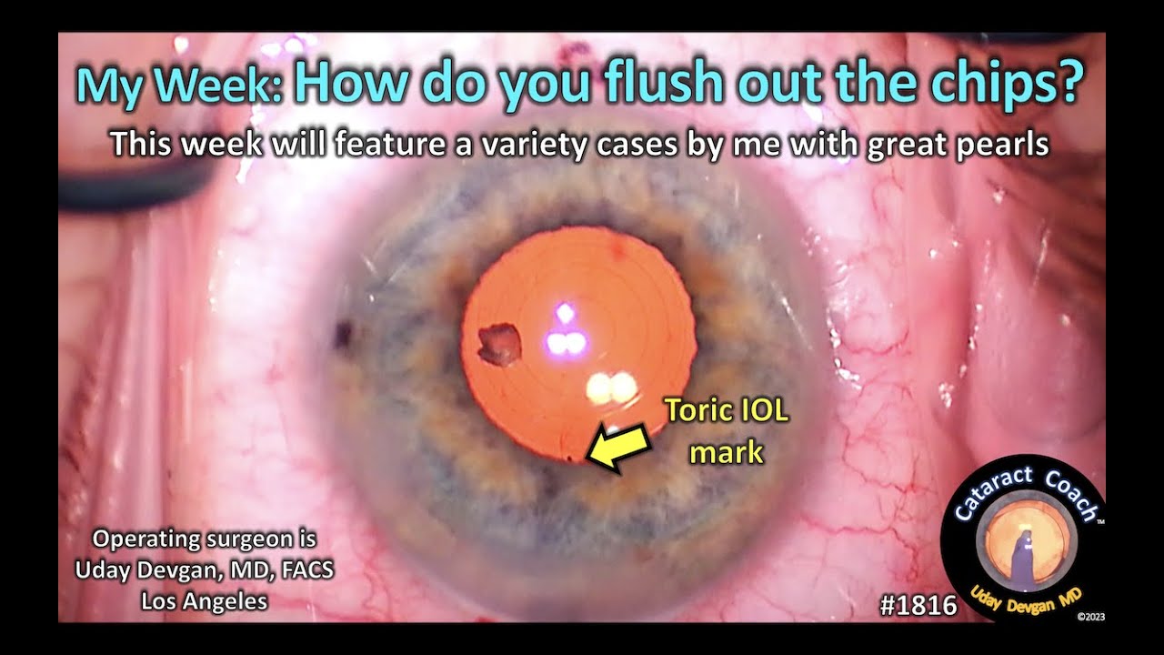 CataractCoach™1816: My Week: flush out nuclear chips - YouTube