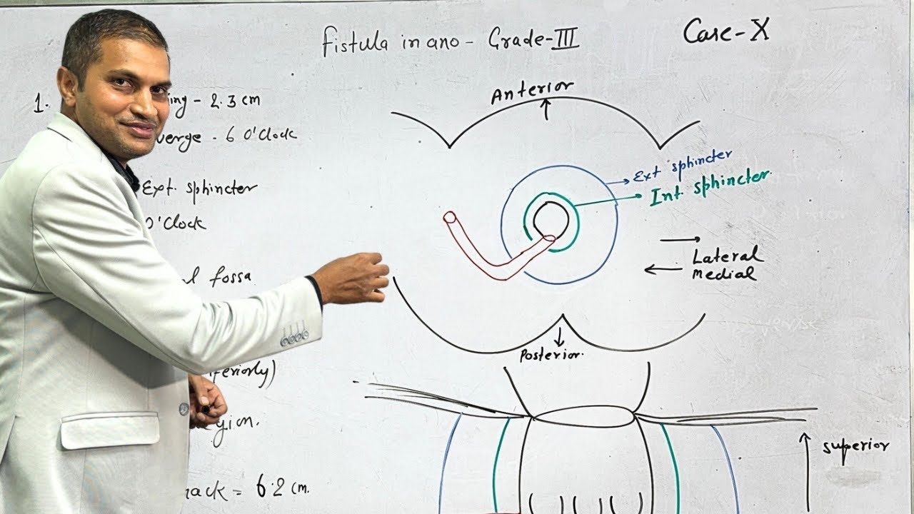 Fistula in Ano Grade 3MRI Fistulogram Reading, Diagram & Treatment Plan ...