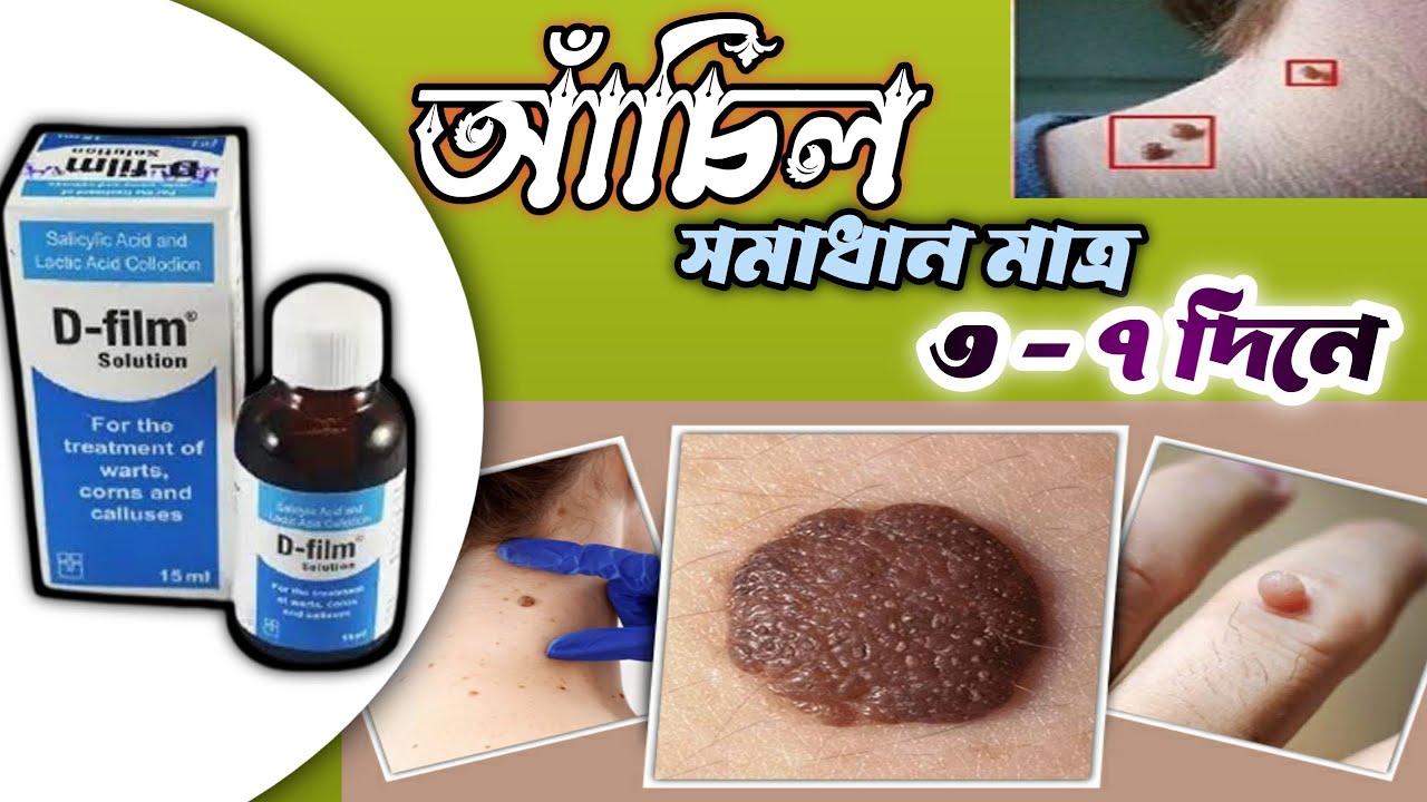 D Film Solution Uses || Warts/আঁচিল দূর করুন মাত্র ৩ দিনে || - YouTube