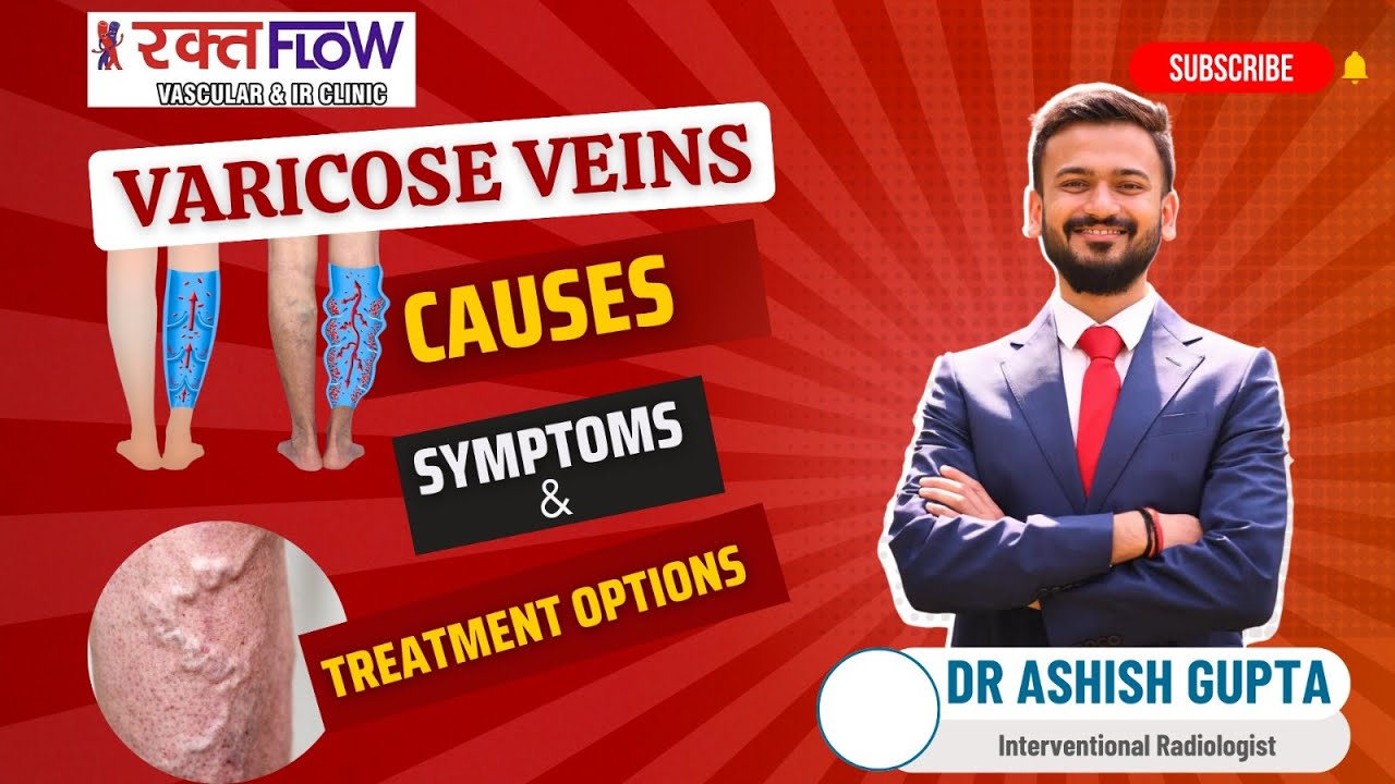 Varicose veins Causes Symptoms & Treatment options. - YouTube