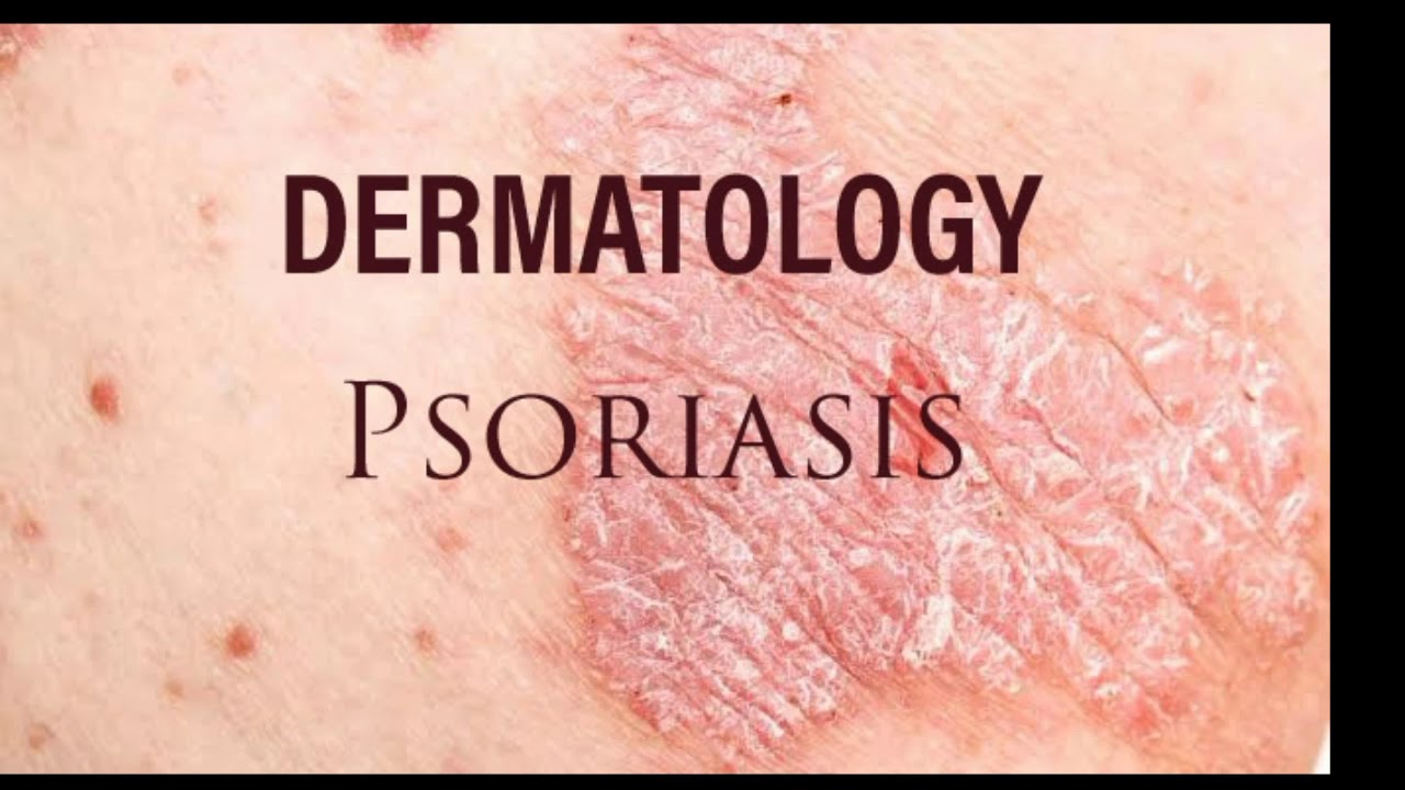 Dermatology - Psoriasis - YouTube