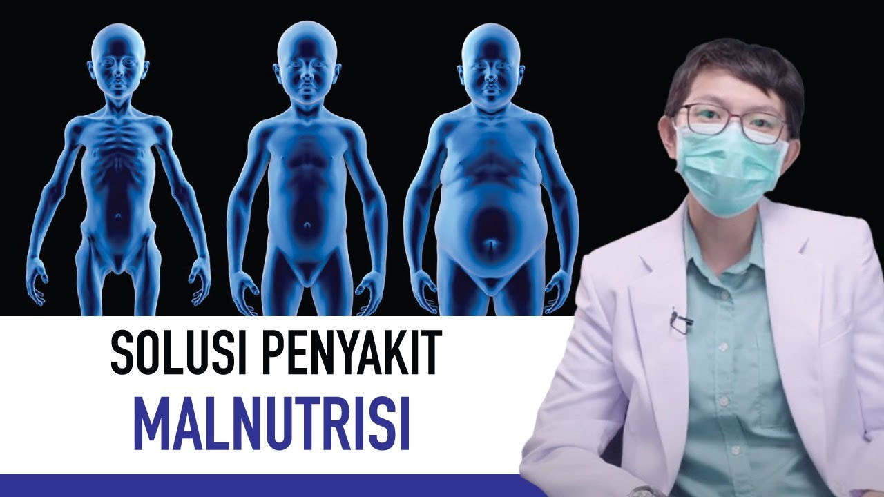 Malnutrisi: Gejala, Penyebab dan Cara Mengatasi | Kata Dokter - YouTube