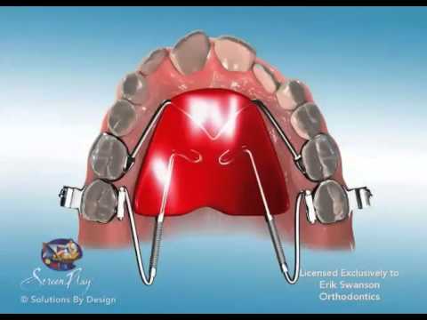 ES Ortho and Distal Jet Appliance - YouTube