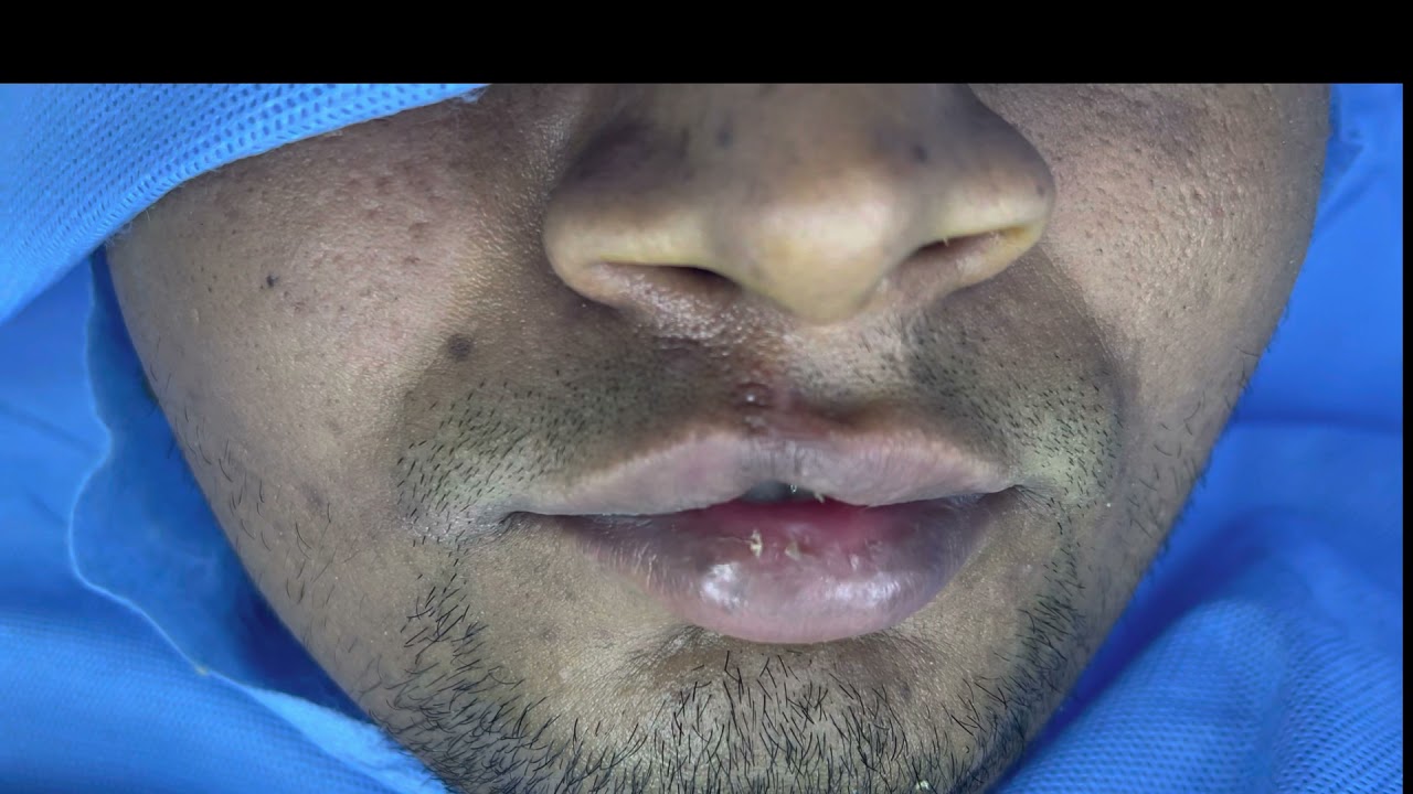 Lip revision - Cleft Lip adult redo surgery to remove scar, make it ...