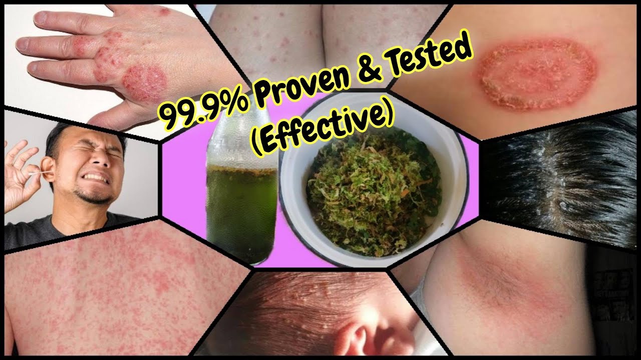 Mabisang Halamang Gamot Para sa Eczema, Sugat, Buni, Makakating Parte ...