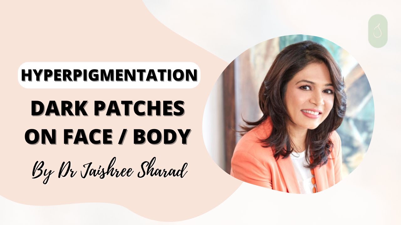 Hyperpigmentation or increased pigmentation or dark patches on face ...
