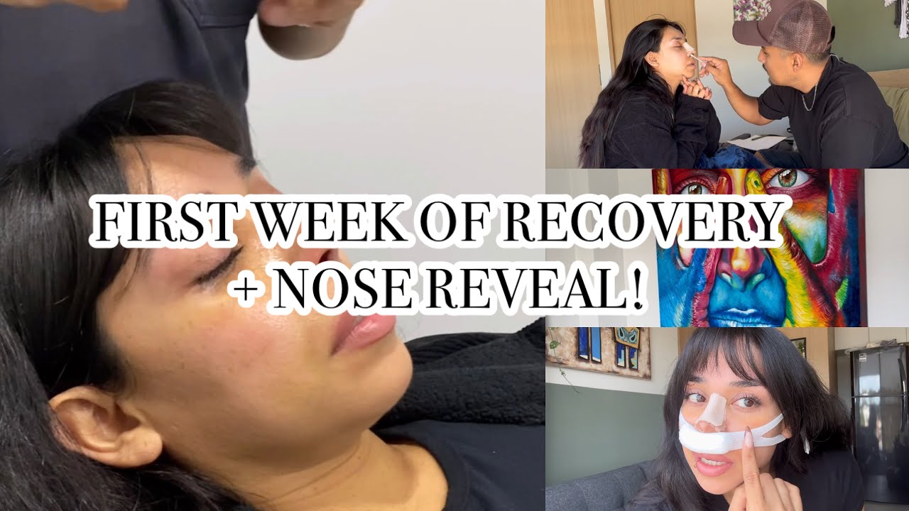 Days 2-7 of My Nose Job + Cast Removal & FIRST LOOK! (Dr. Luis Sandoval ...