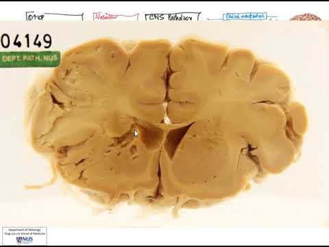 CNS Pathology I: Raised ICP, Cerebrovascular disease and Intracranial ...