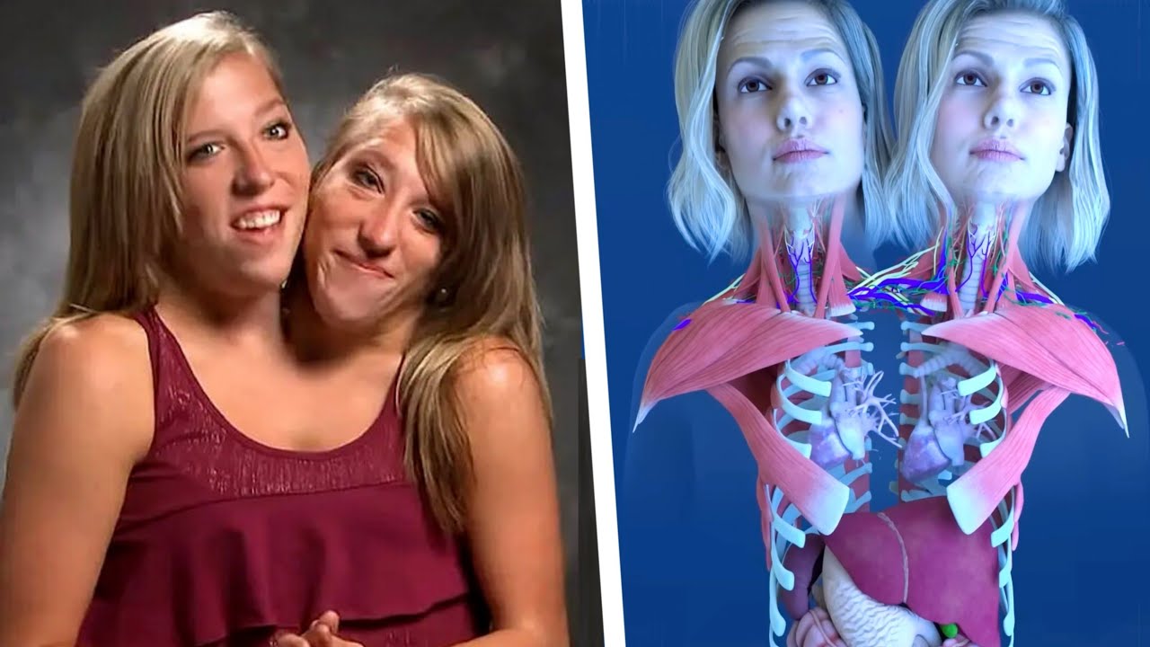 رأسين في جسد واحد | شاهد تشريح التوأم الملتصق _ Two Heads, One Body ...