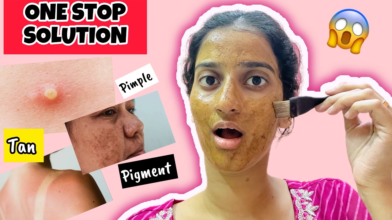 🔥😍 * ONE STOP SOLUTION * - Pimple , Open pores , dull skin ‼️ ...