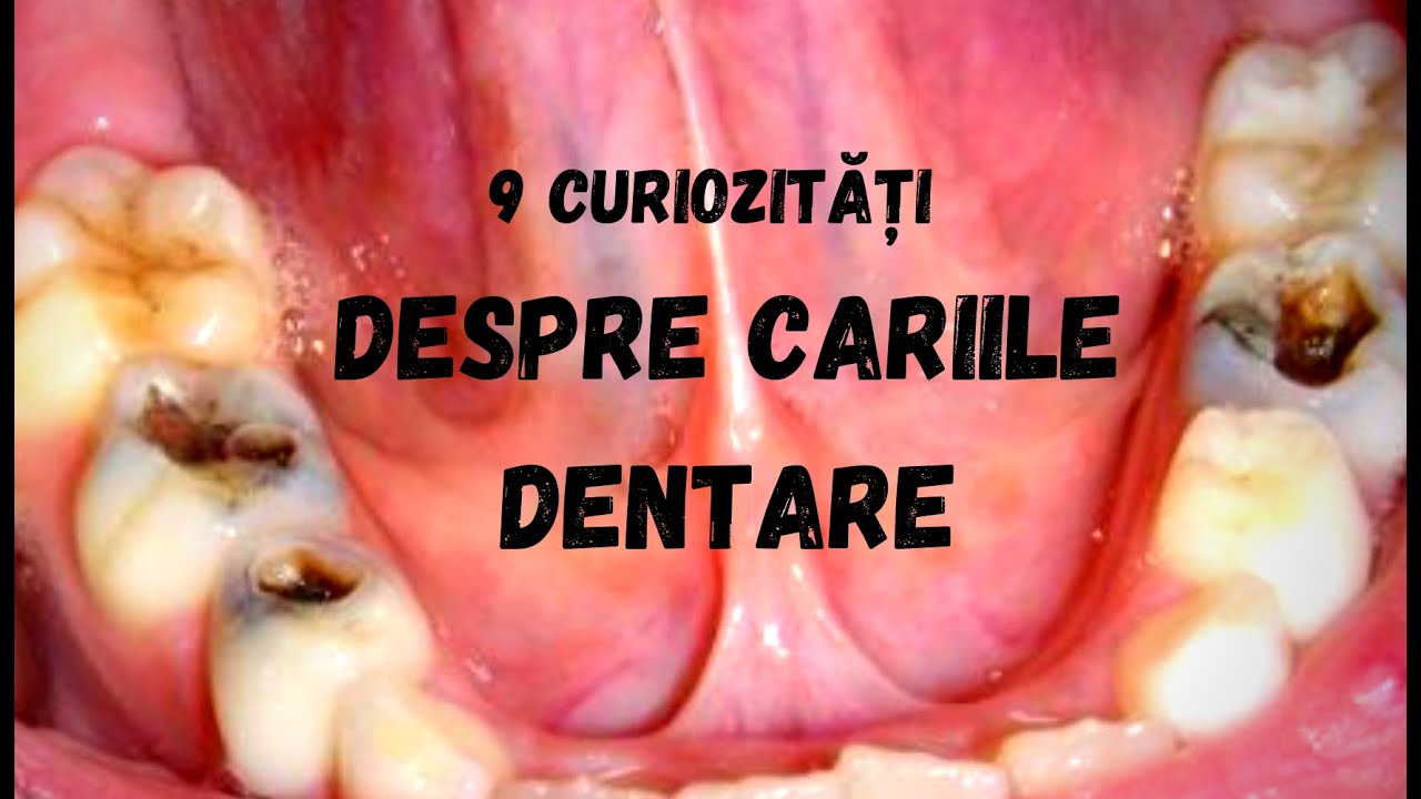 9 curiozități despre cariile dentare - YouTube
