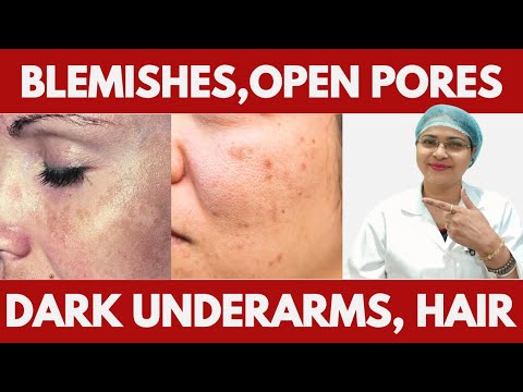 Blemishes, Open Pores, Dark Underarms, Hair Fall | All Problem Solution ...