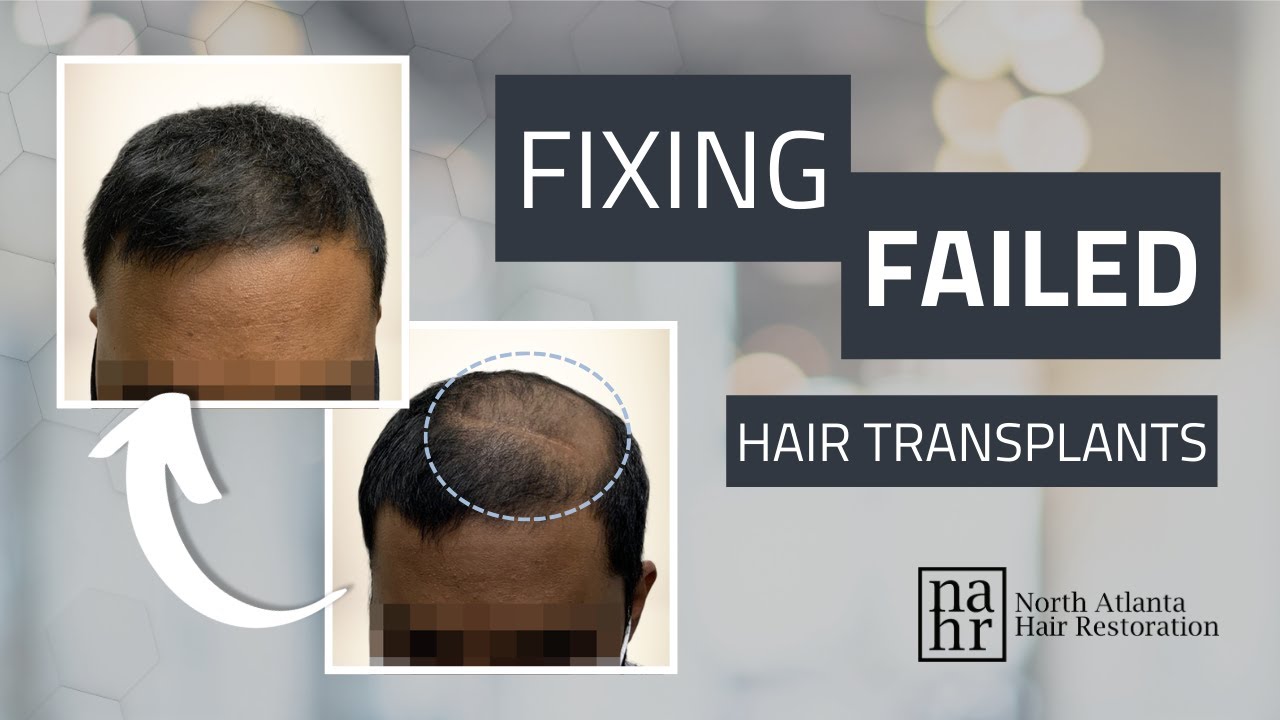 Fixing Failed Hair Restoration Procedures - YouTube