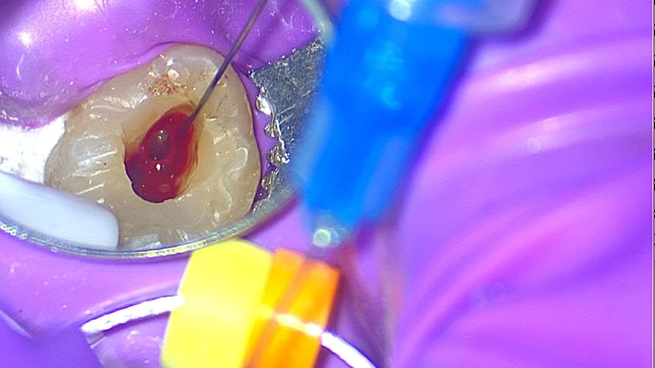 How to Stop a Bleeding Canal - YouTube