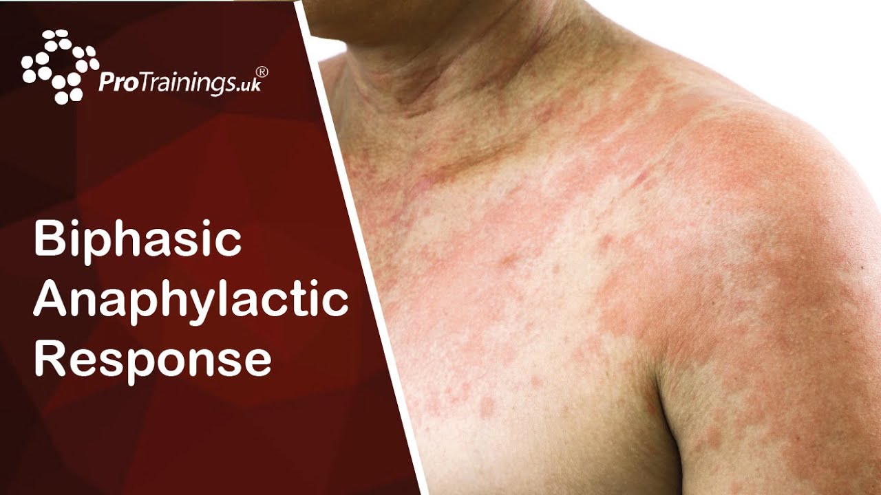 Biphasic Anaphylactic Response - YouTube