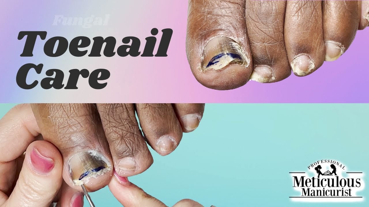 👣Let's Revisit - Toenail Fungus Care at Home👣 - YouTube
