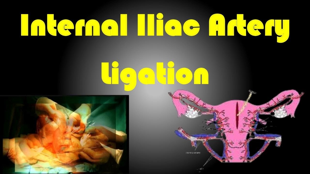 Internal Iliac Artery Ligation / Internal Iliac artery Ligation ...