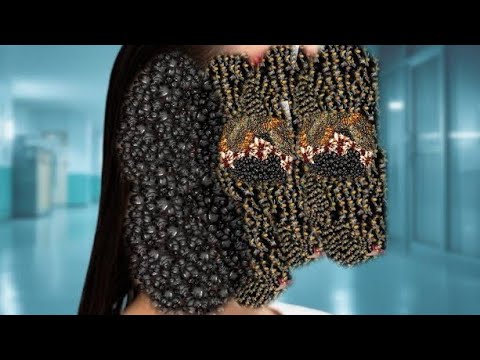 ASMR Dog Ticks Remove and Maggots Infected face | 2D Treatment ...