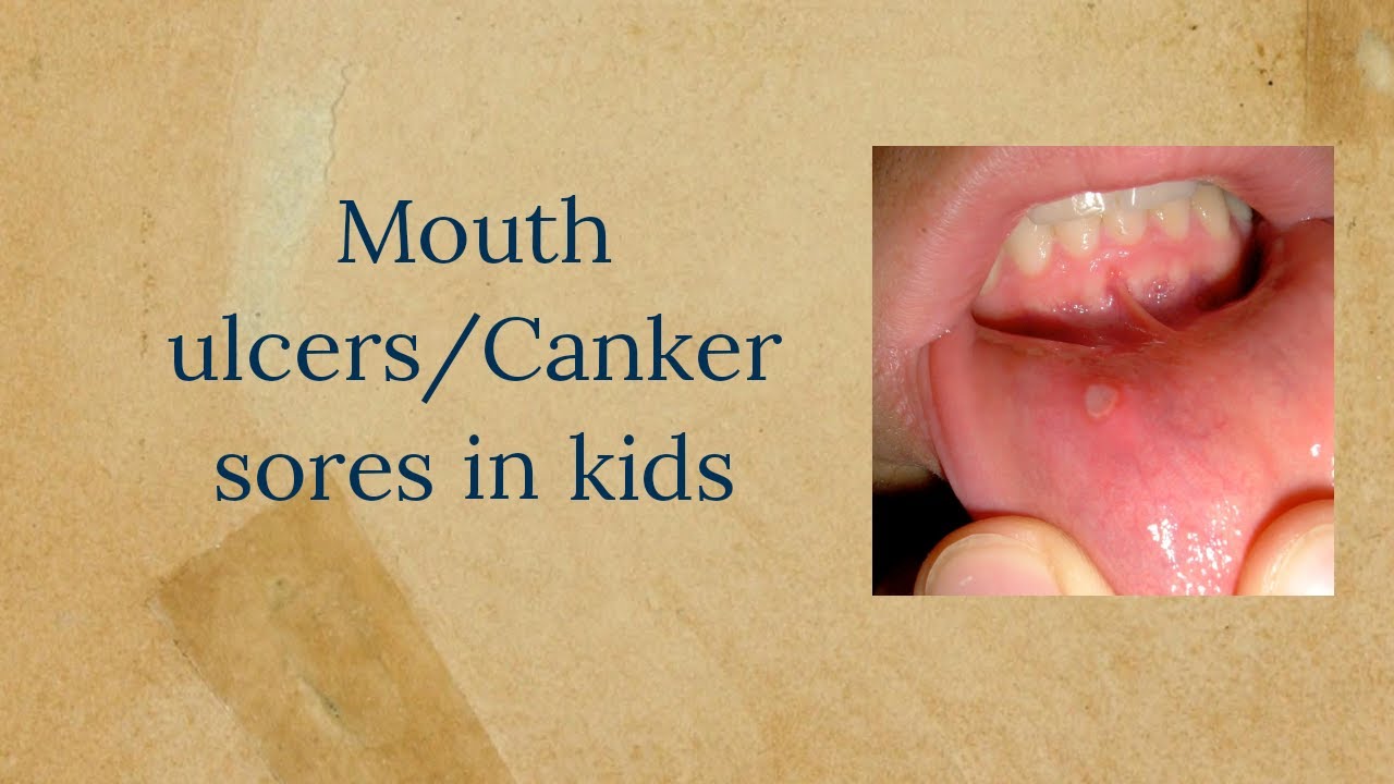 Mouth ulcers/canker sores in kids || caring tips || Home remedies - YouTube