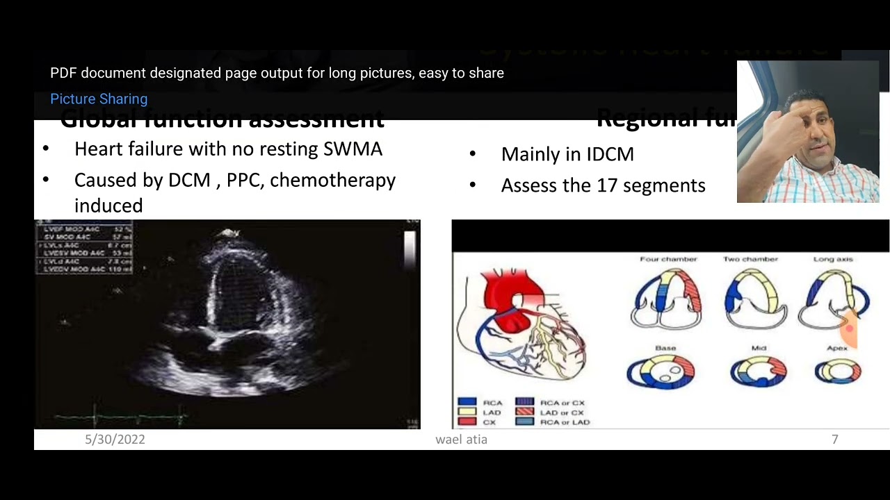 easy way to assess LV systolic function by echo - YouTube