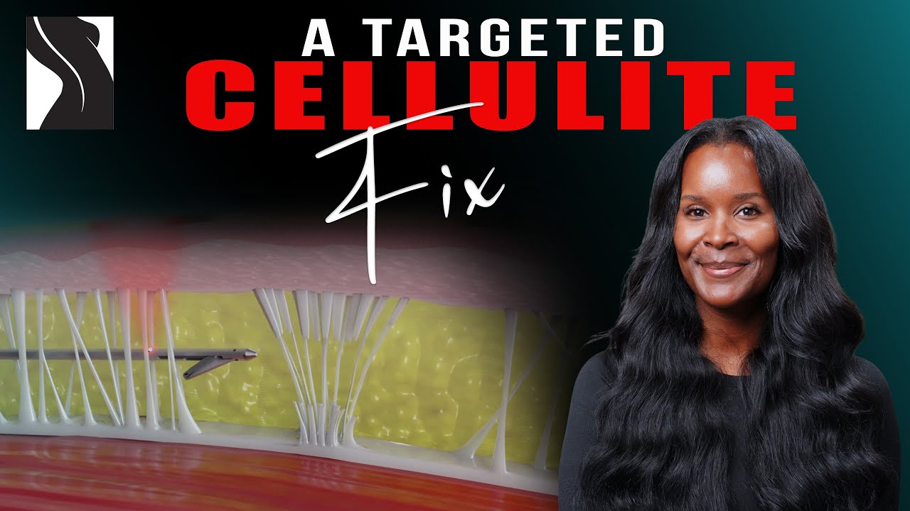 The Procedure That Targets Cellulite at the Root | AVELI with Kori ...