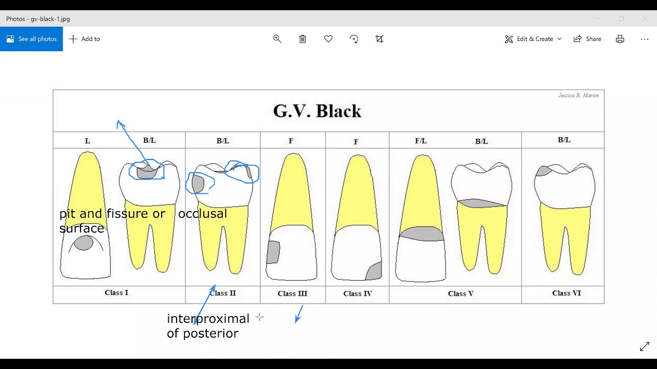 classification of dental caries (GV Black) - YouTube