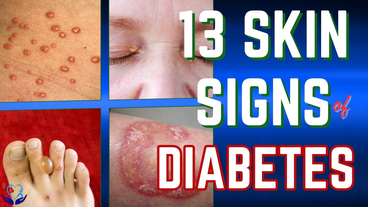 Discover 13 Skin Signs of Diabetes Now! - YouTube