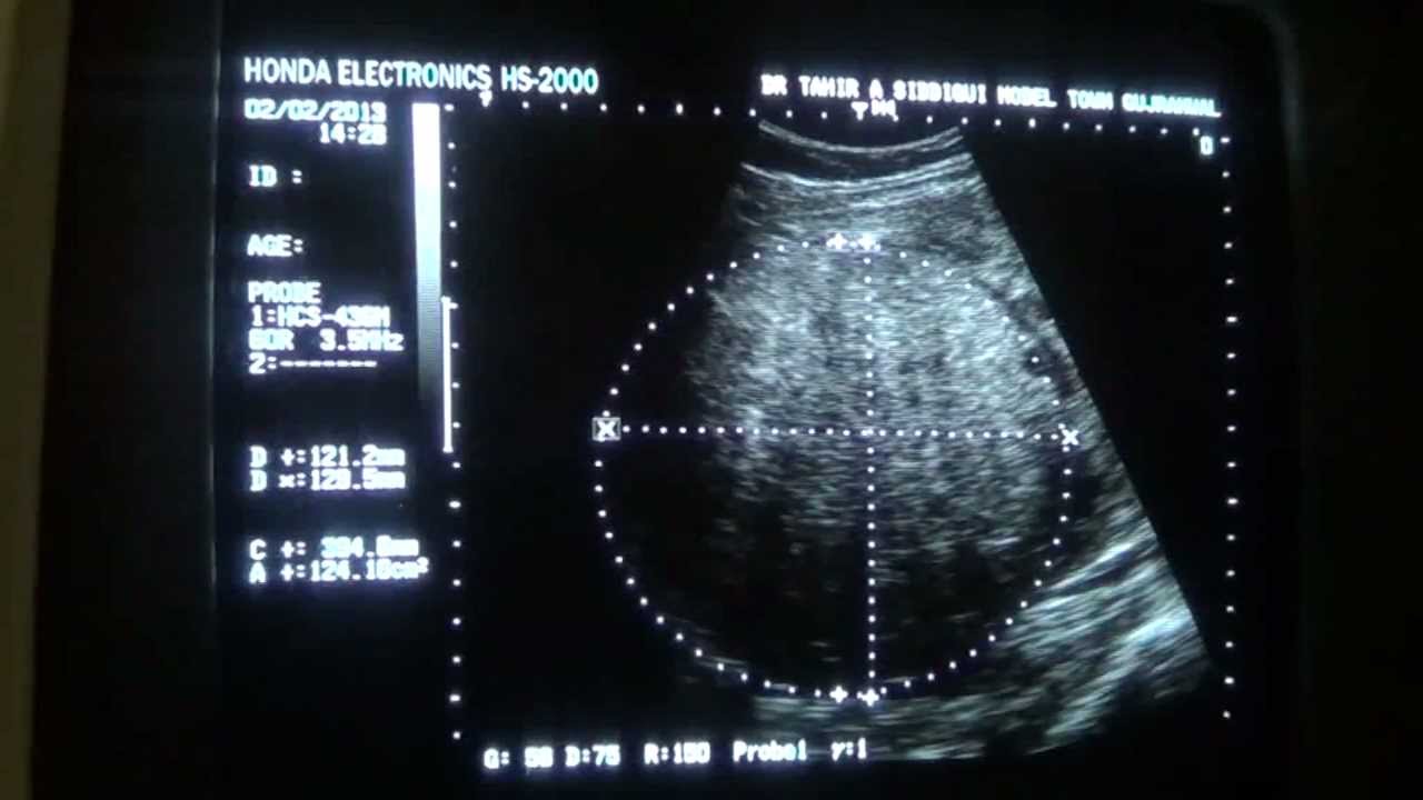 POSTERIOR UTERINE WALL FIBROID - YouTube