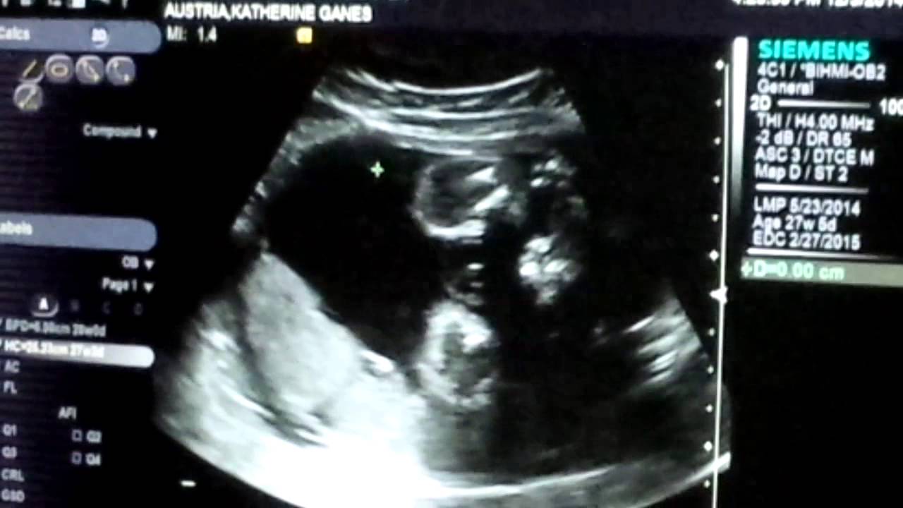27 Weeks Ultrasound Boy
