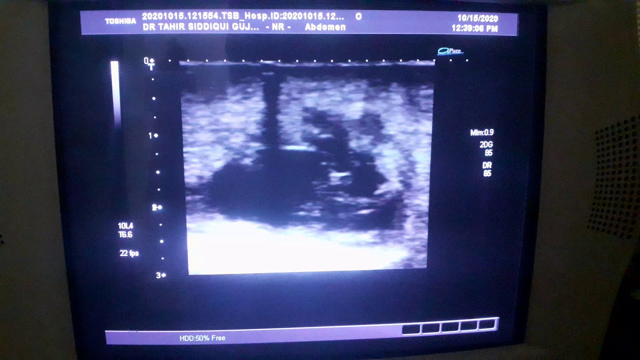 RT INGUINAL REGION SUBCUTANEOUS ABSCESS - YouTube