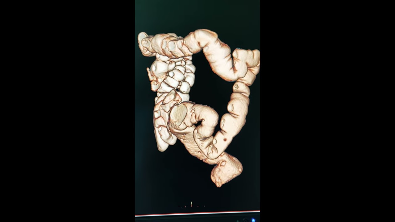 Multiple colon polyp - YouTube