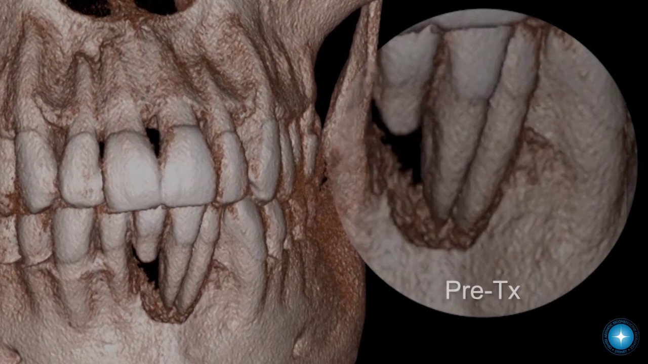 Horizontal & Vertical Ridge Augmentation Dr Christopher Ho - YouTube