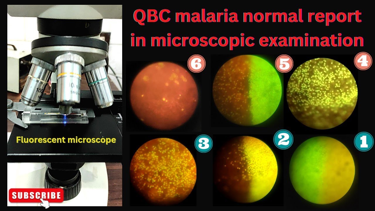 QBC malaria normal report under microscopic examination ...
