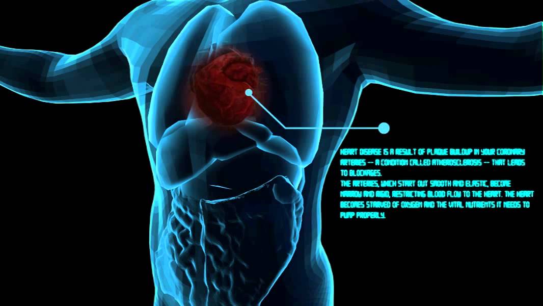 3D medical video sample. Xray effects - YouTube