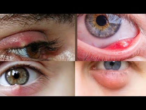 Şalazyon nedir? Arpacık neden olur? Şalazyon neden olur? Şalazyon-arpacık tedavisi nedir? Arpacık?