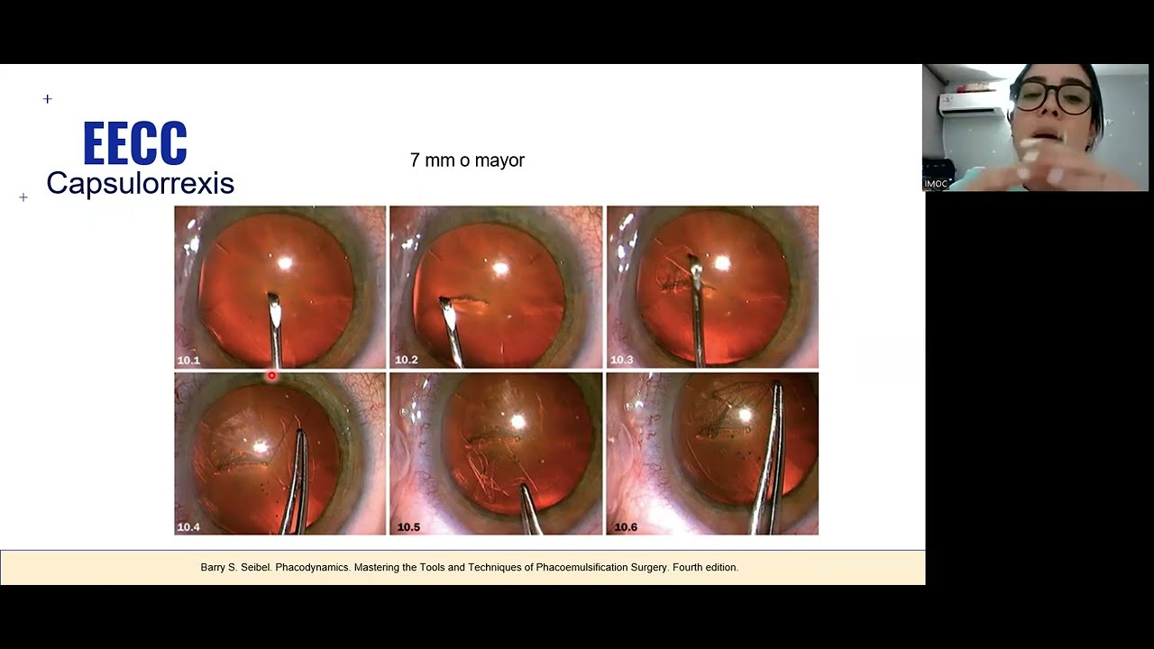 Extracción extracapsular de cataratas. Dra. Gabriela Molina - YouTube