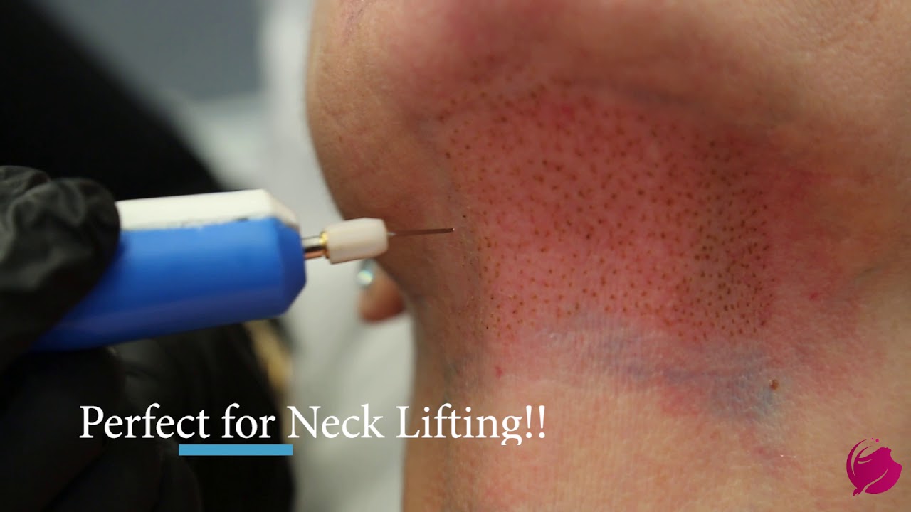 Neck Lifting with Felc Nano Plasma - YouTube
