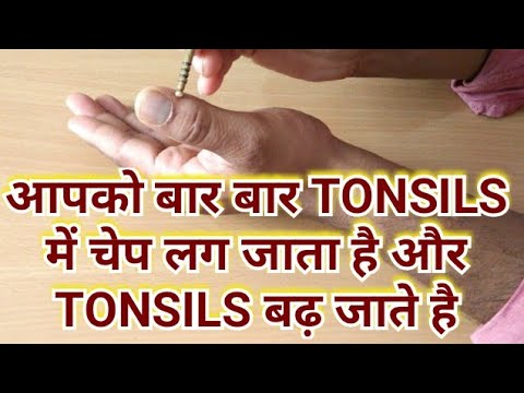 Acupressure Points For TONSILS || TONSILLITIS || Tonsillitis Home ...