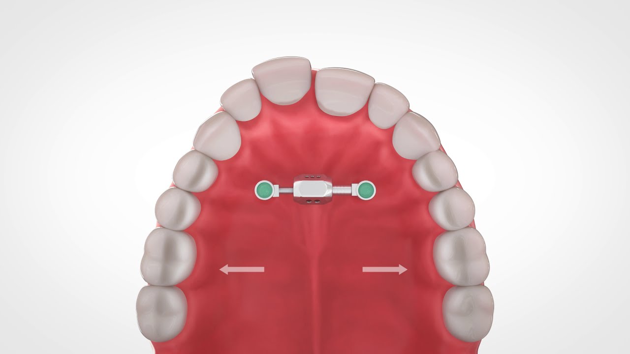 MICRO2 Expander - YouTube