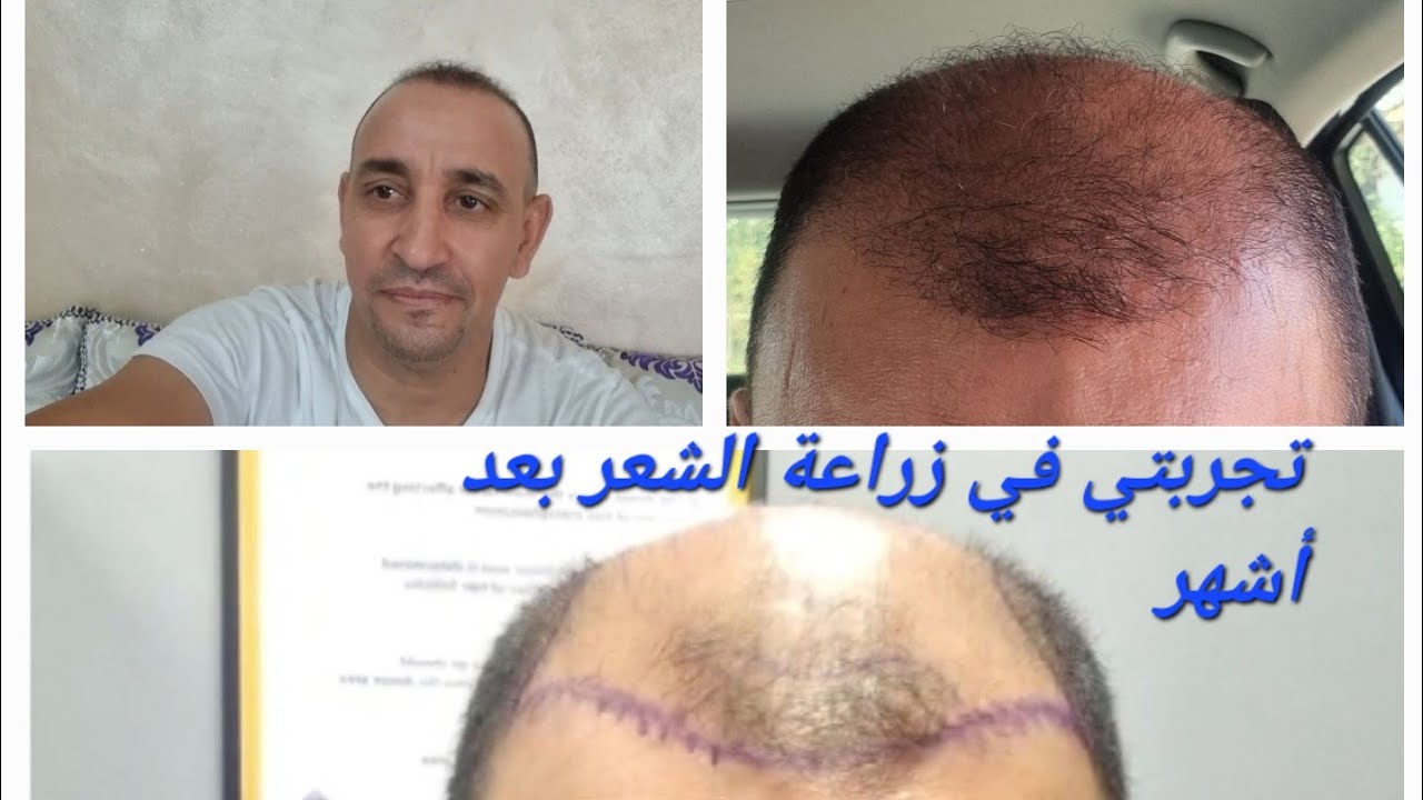 تجربتي في زراعة الشعر بعد أشهر Youtube